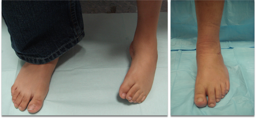 Clubfoot Reconstruction | Naples, Miami Florida & New York City
