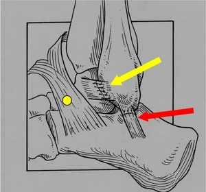 Broström–Gould Ankle Ligament Reconstruction | Ankle Instability ...