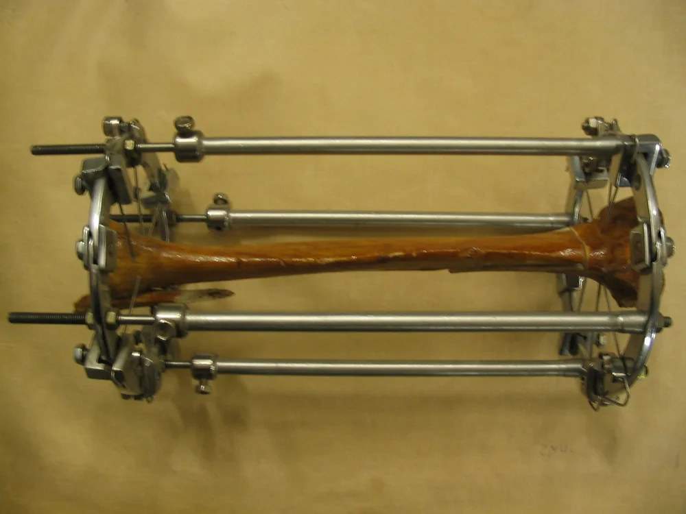 ilizarov external ring fixation -Foot & Ankle Surgery