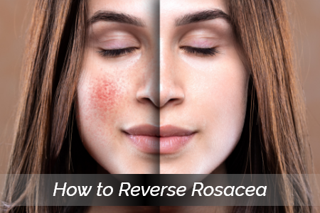 Types of Rosacea and treatments — You By Sia - Skin & Laser Clinic ...