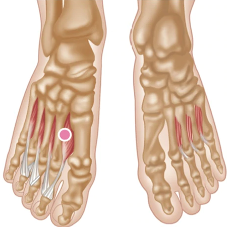 Using Cupping to Treat the Deep Muscles of the Foot — Stuart Hinds Academy