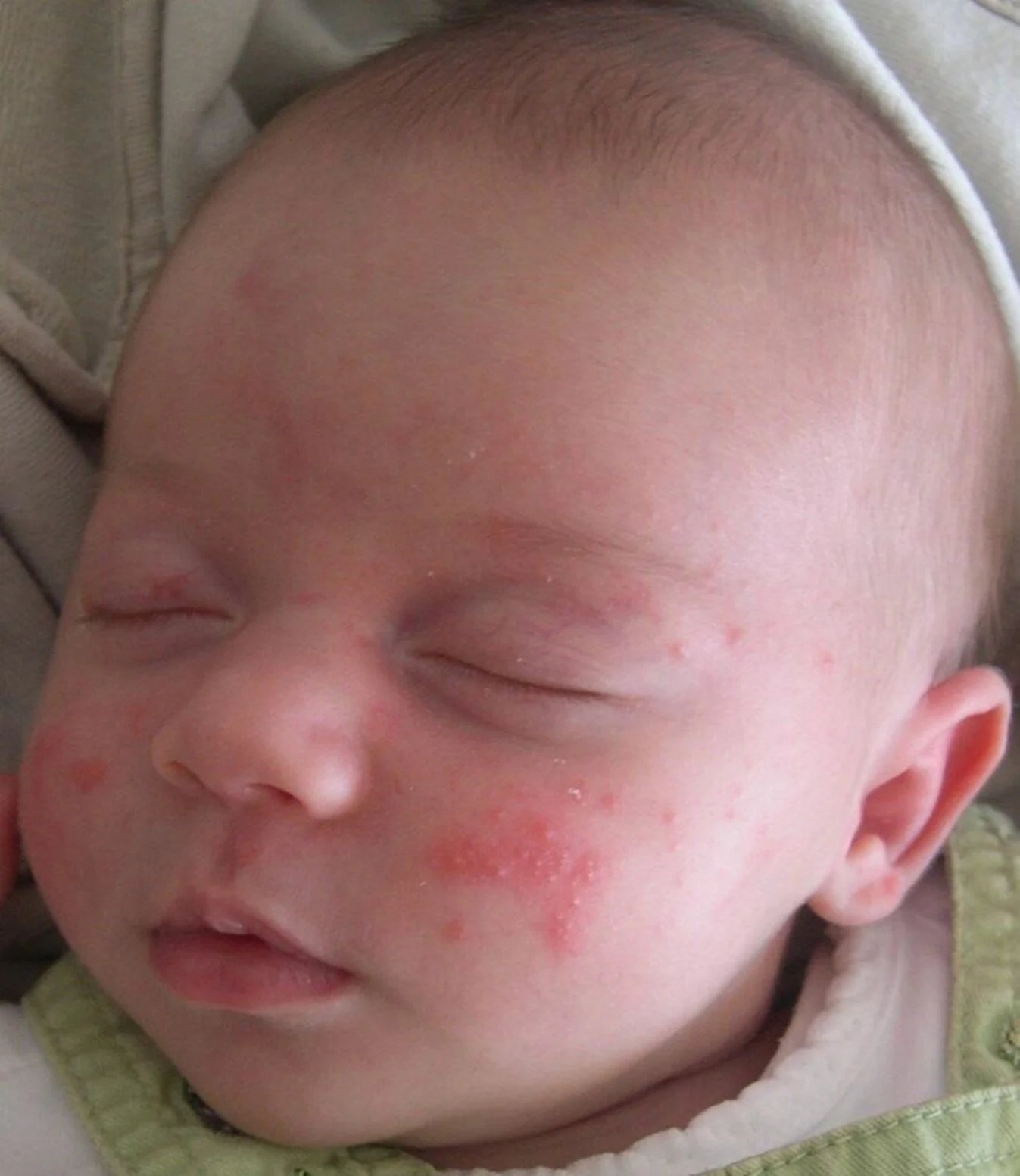 Rashes In Toddlers