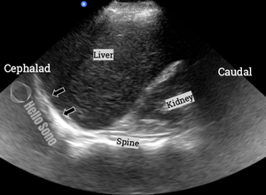 Diagnosing Pneumonia with Point-of-Care Ultrasound (POCUS) in Primary ...