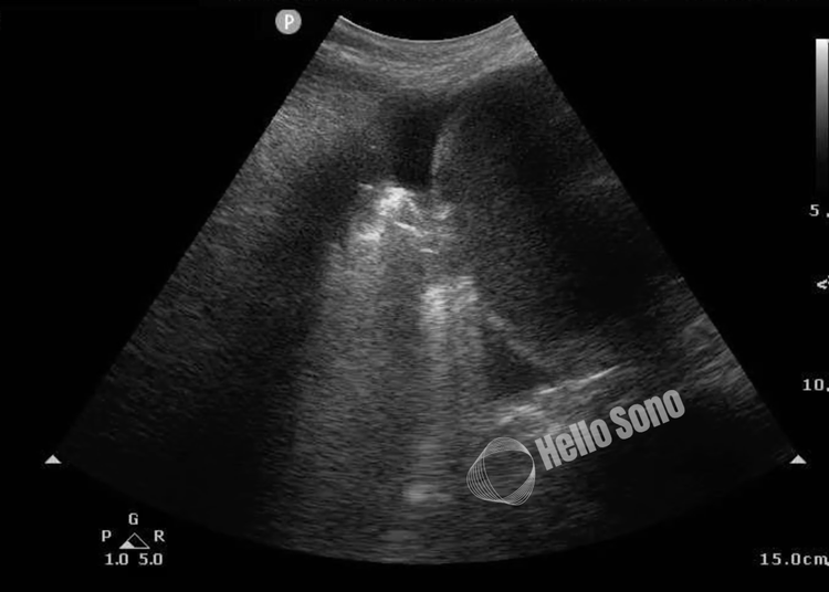 Diagnosing Pneumonia with Point-of-Care Ultrasound (POCUS) in Primary ...