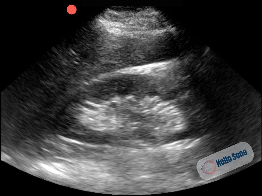 Acute Flank Pain: How Point-of-Care Ultrasound (POCUS) Detects ...