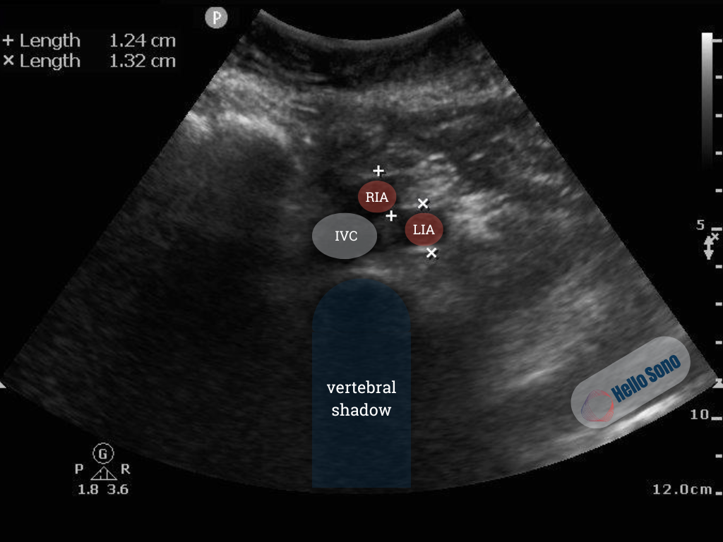Abdominal Aortic Aneurysm Screening: How Point-of-Care Ultrasound ...