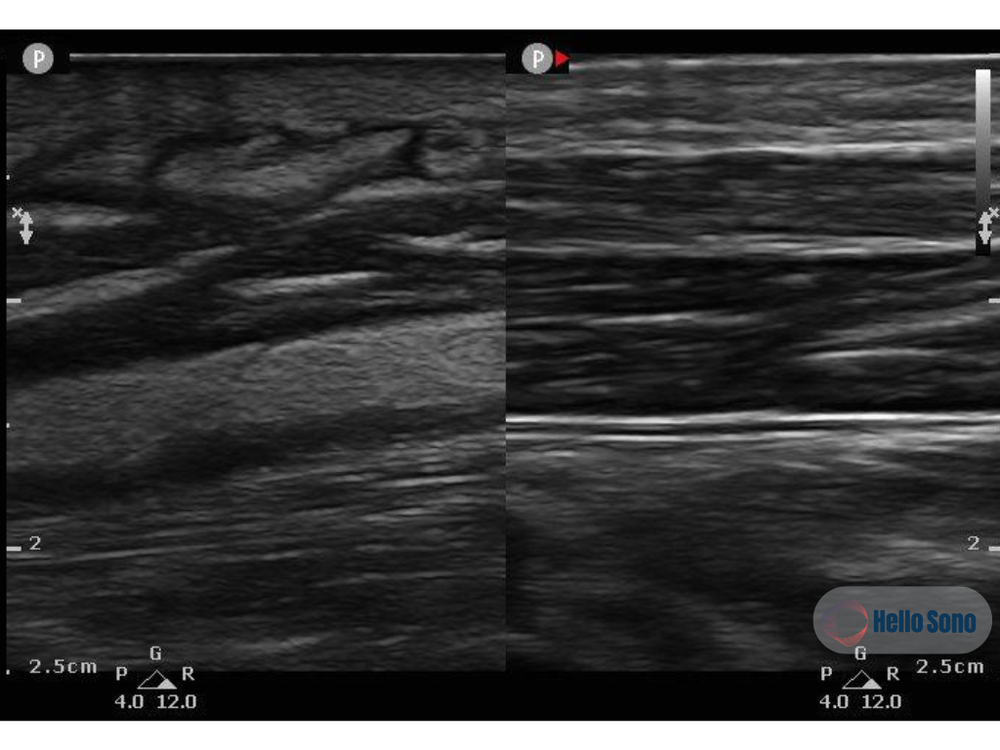 Soft Tissue Infections: How Point-of-Care Ultrasound (POCUS ...