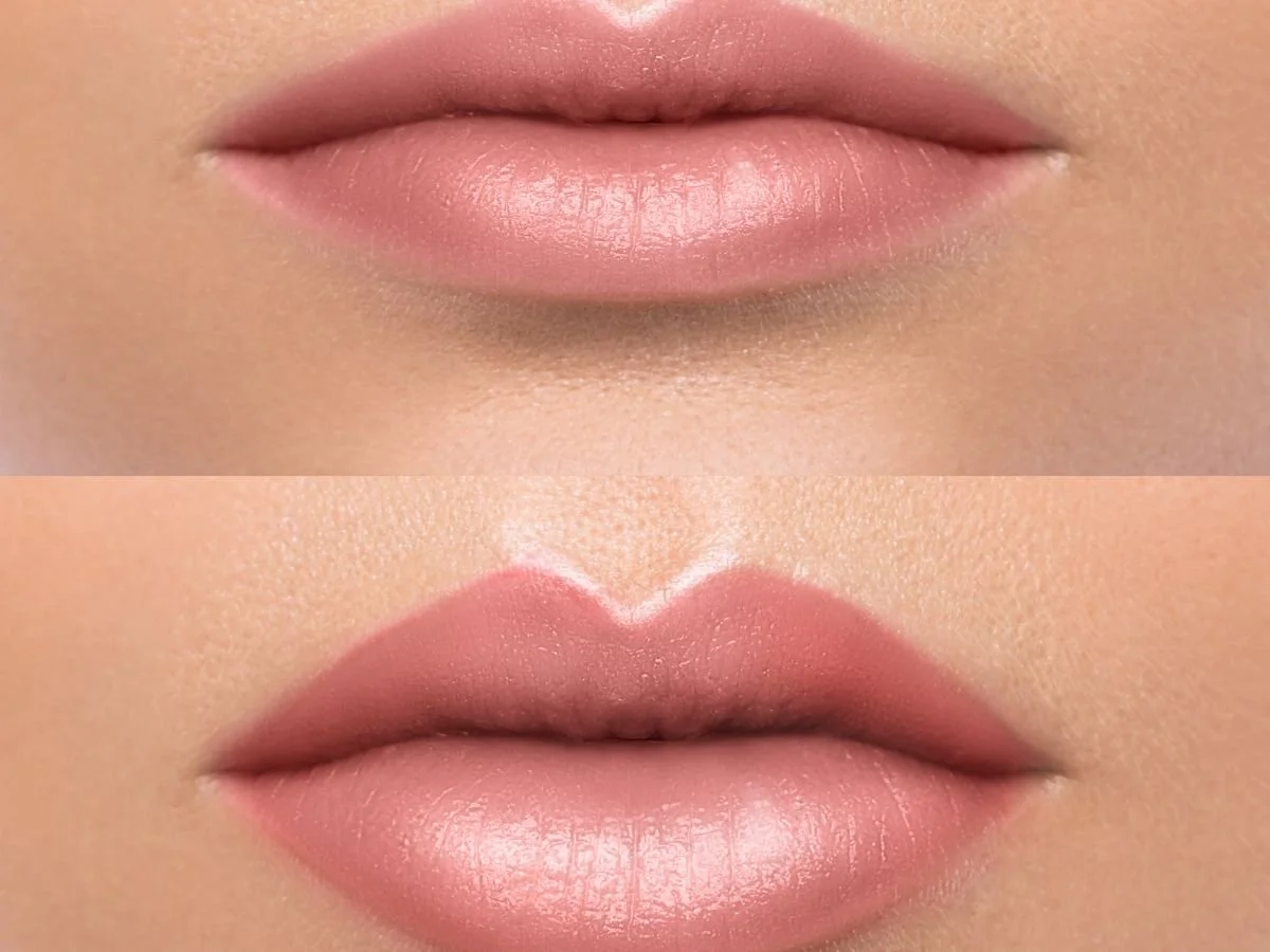Lip Fillers: Age Requirements & Expert Insights