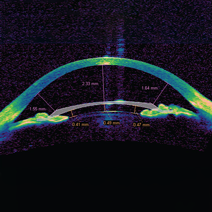 Corneal Pachymetry — Eye Academy