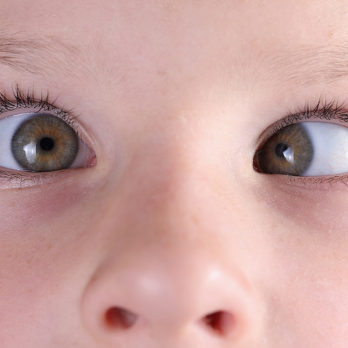 Squint & Lazy Eyes — Eye Academy