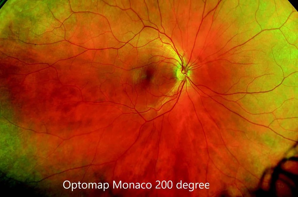 Optomap Scans - Advanced Retina Technology — Eye Academy