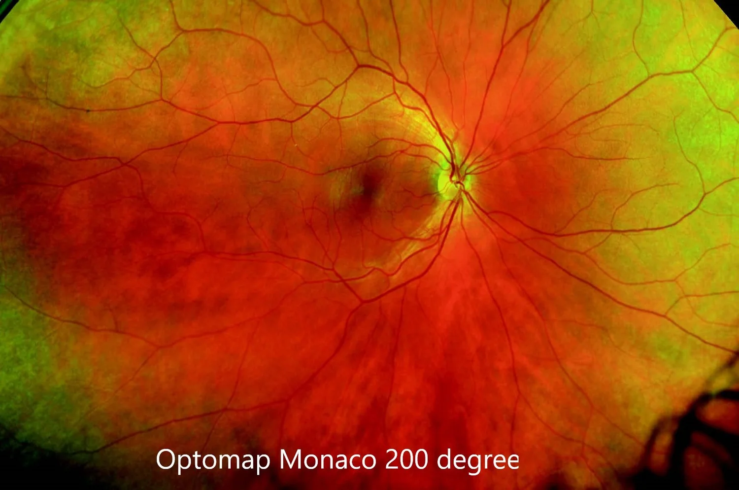 Optomap Scans - Advanced Retina Technology — Eye Academy