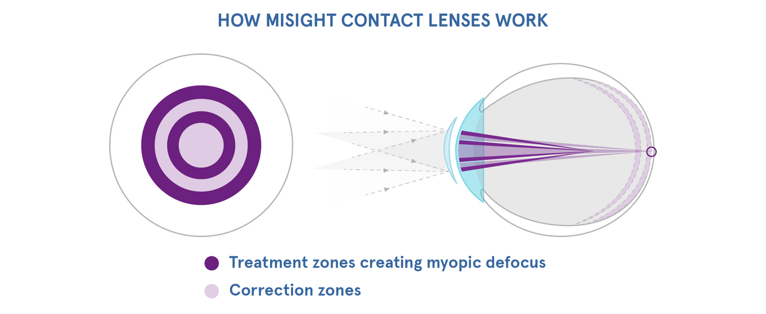 MiSight Daily Myopia Control Contact Lenses — Eye Academy
