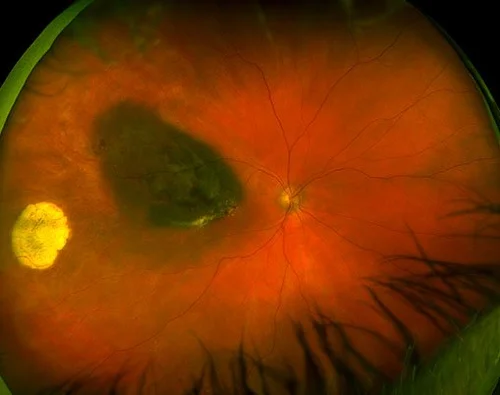 Optomap Scans - Advanced Retina Technology — Eye Academy