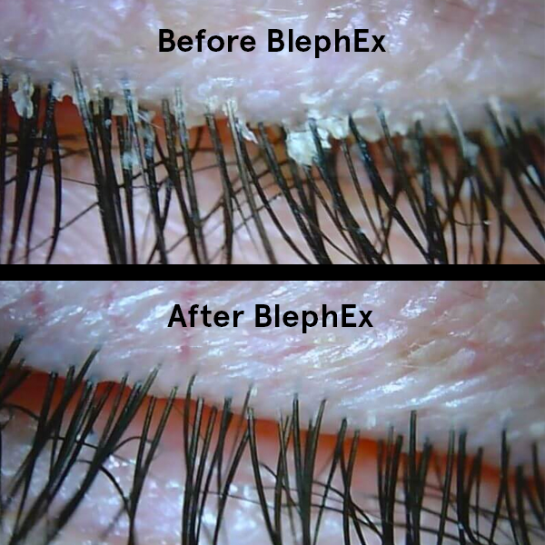 BlephEx Lid & Lash Cleaning for Blepharitis — Eye Academy