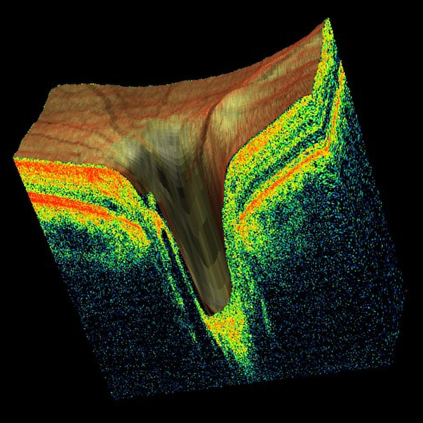 Heidelberg Spectralis 4D OCT Scan — Eye Academy