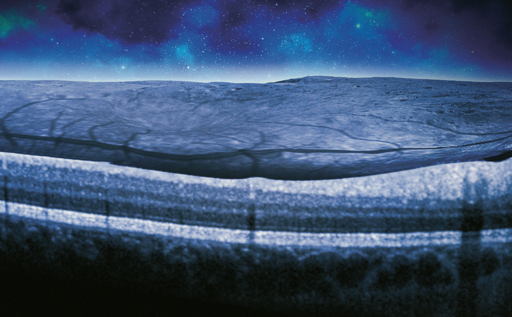 Heidelberg Spectralis 4D OCT Scan — Eye Academy