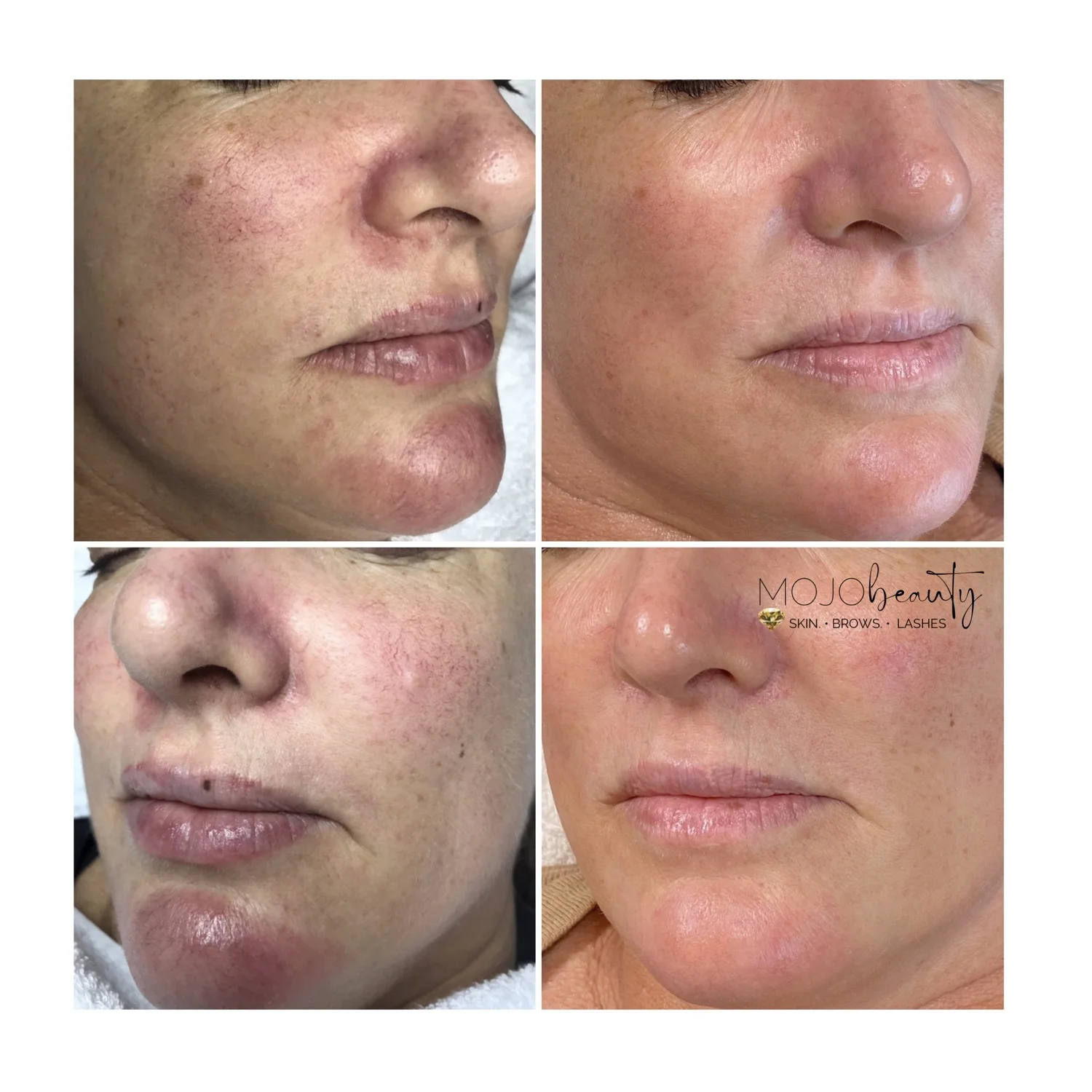 Micro-Dermal Needling | Mojo Beauty Skin, Brows & Lashes Fendalton Christchurch