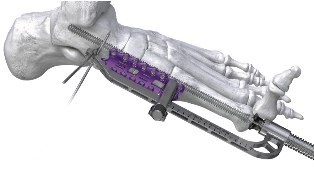 Synergy Ortho in partnership with Paragon 28 — SynergyOrtho