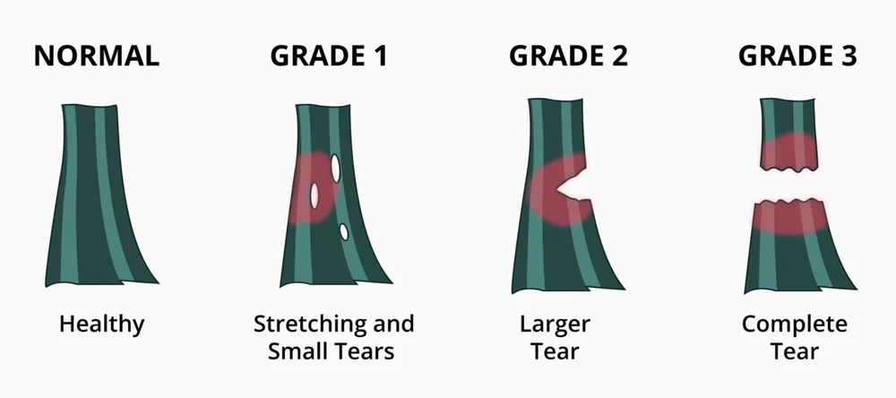 Muscle Strains vs Ligament Sprains — HealthyHips.ca