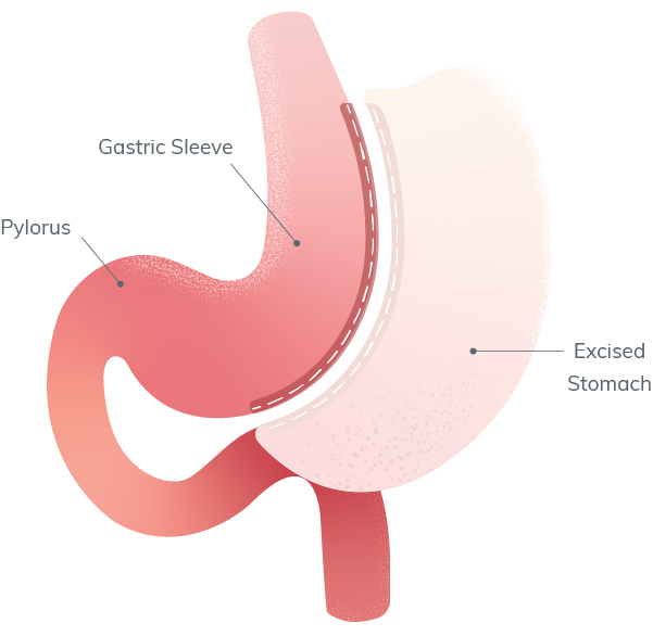 Gastric Sleeve Operation - Options & Advice | Tailor Clinics
