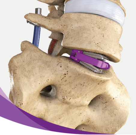 TLX Expandable Cage — Theo Concepts