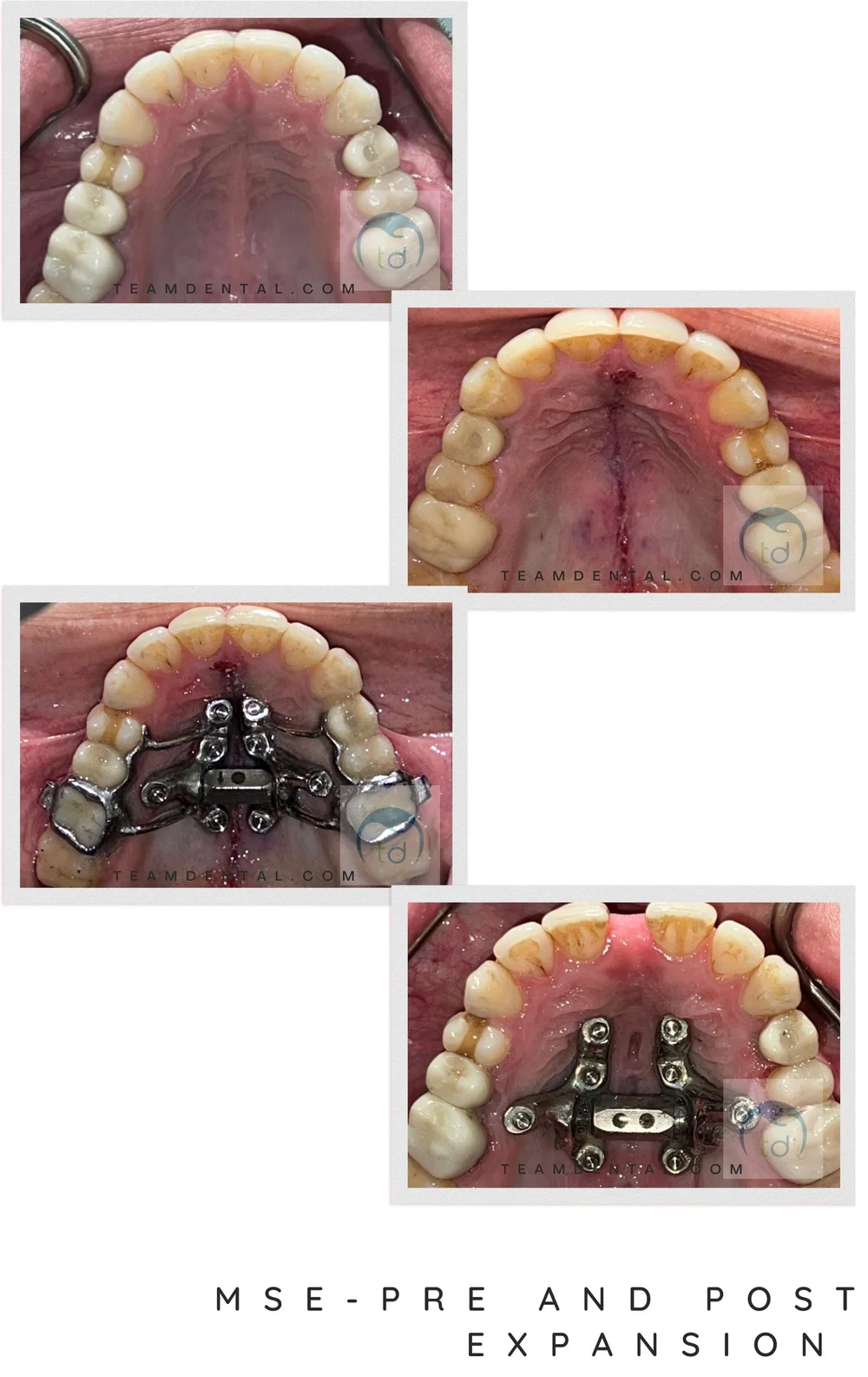 Maxillary Skeletal Expansion (MSE) - How It Works