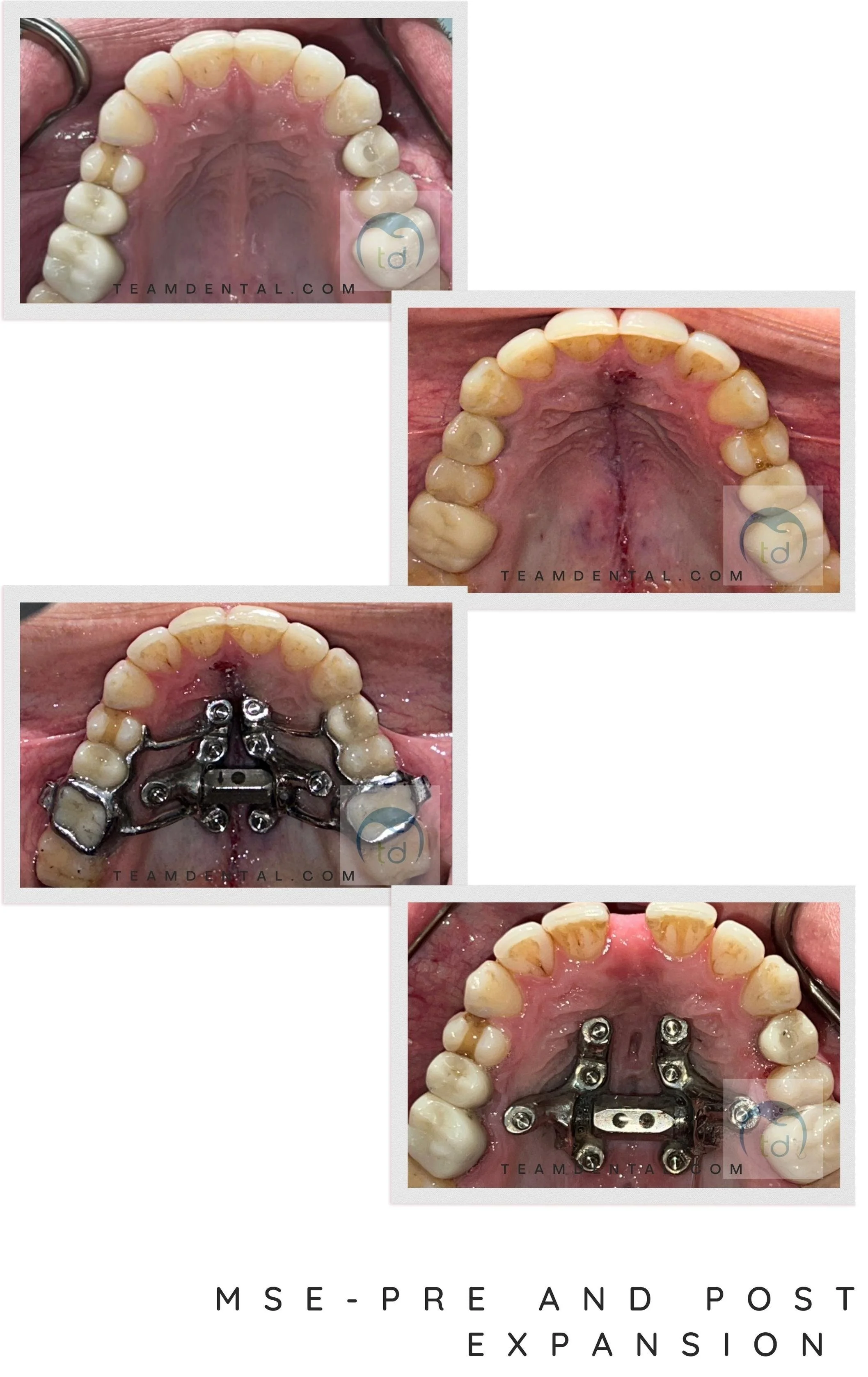 Maxillary Skeletal Expansion (MSE) - How It Works
