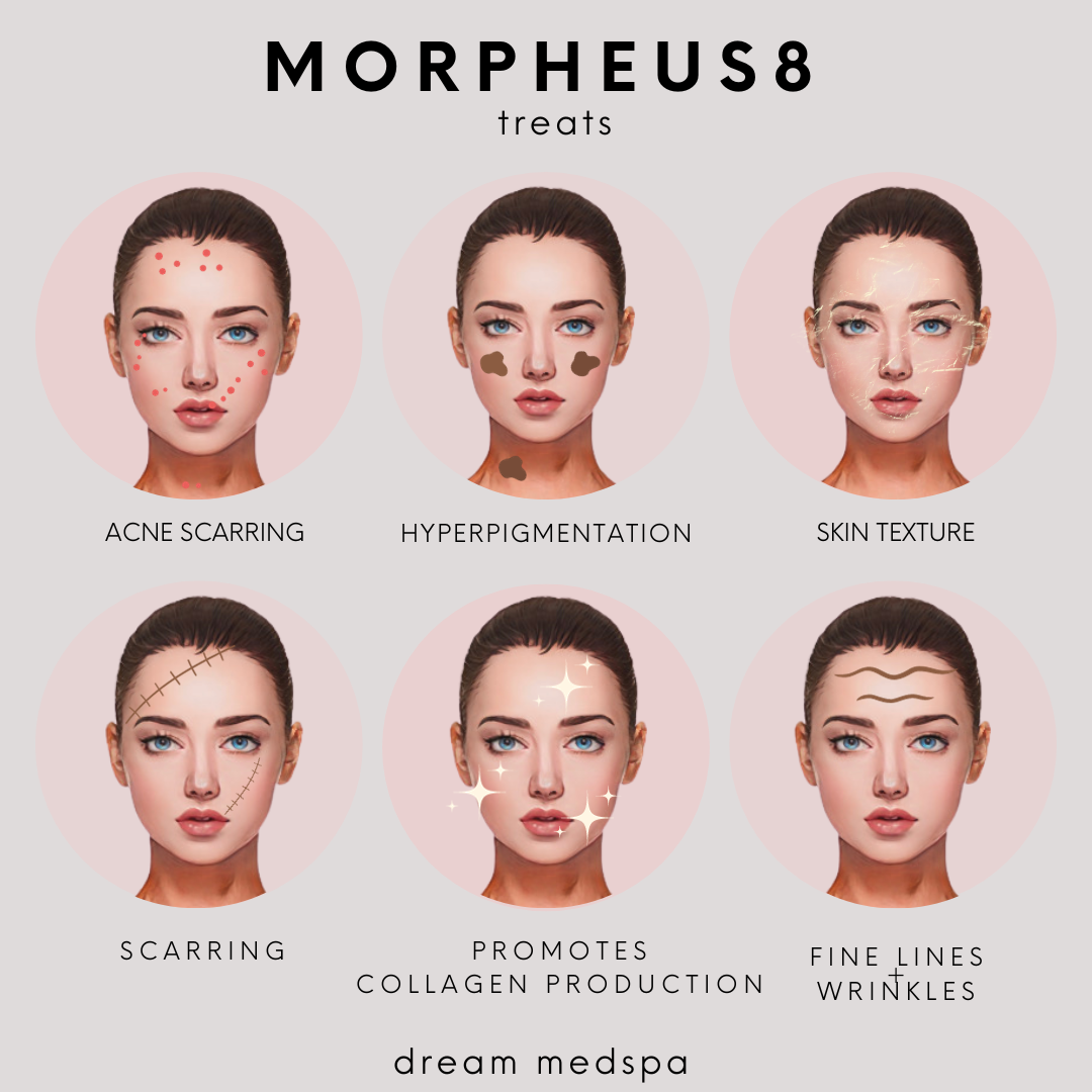 What Does Morpheus8 Treat?