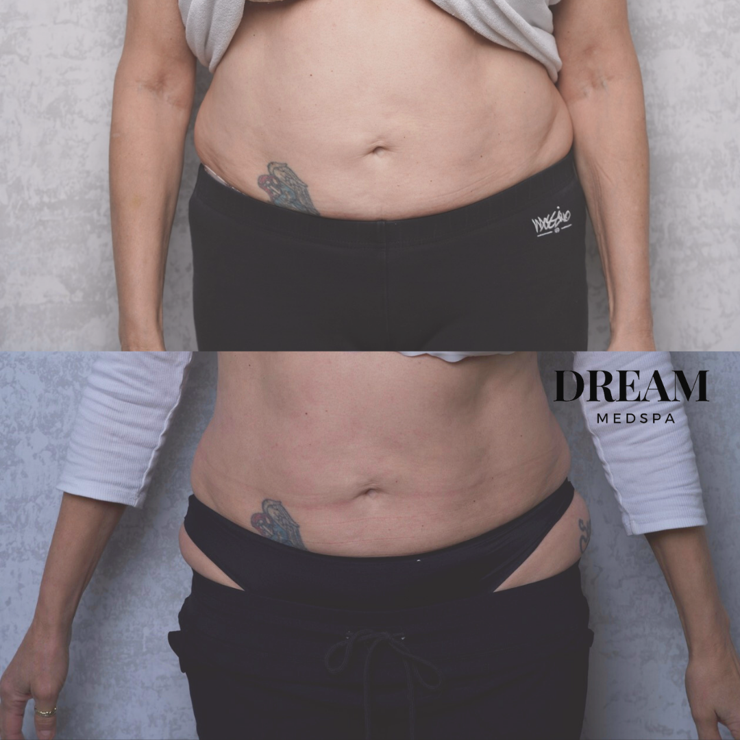 Morpheus8 Body Before & After | Real Results from Denver Clients