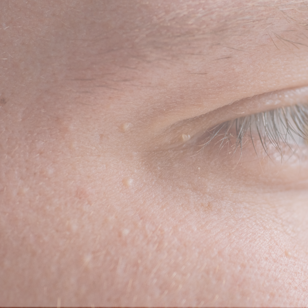 Milia Extraction in Denver | Smooth, Clear Skin at Denver Dream Medspa