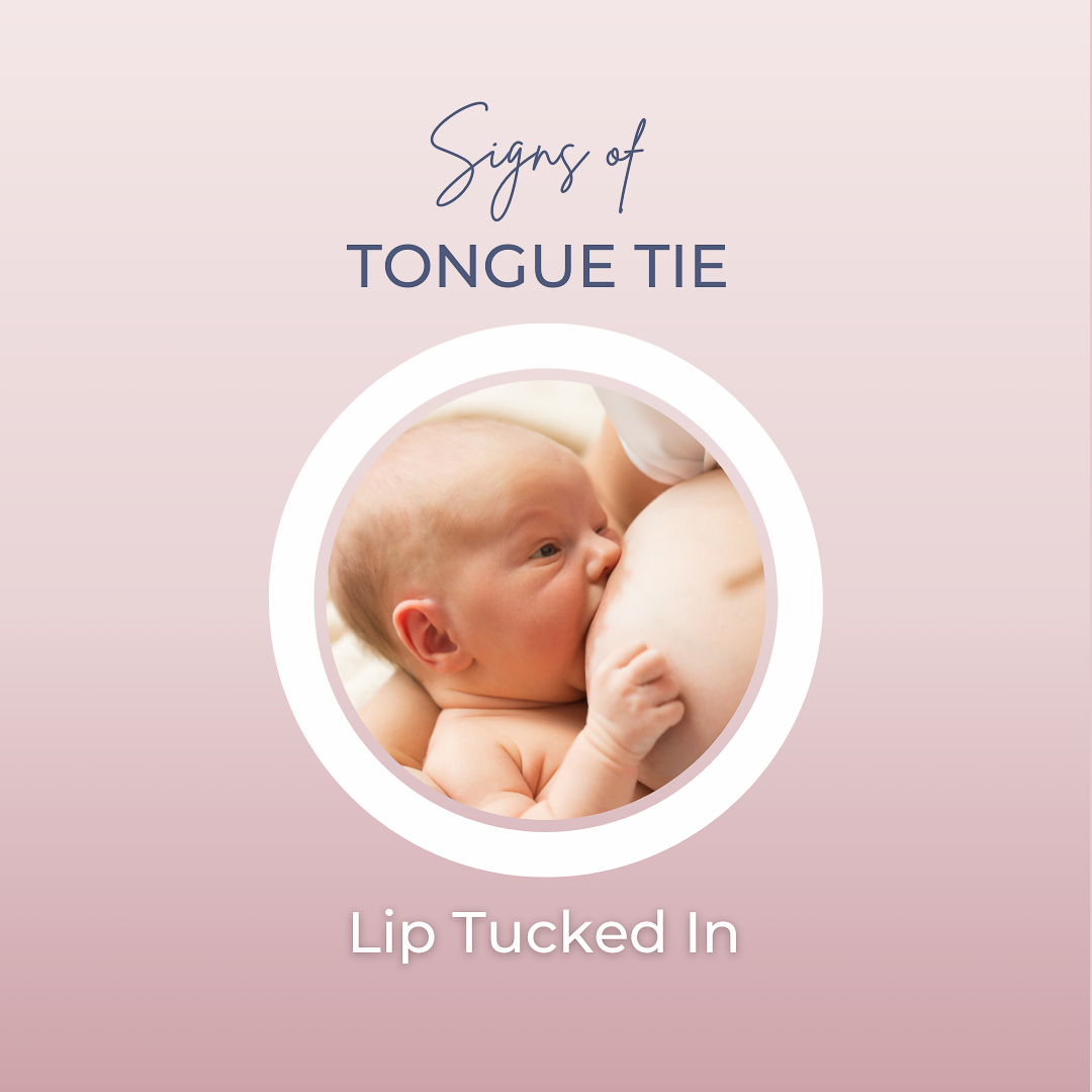 Baby Tongue Tie (Ankyloglossia) — Lactation Consultant Charleston, SC