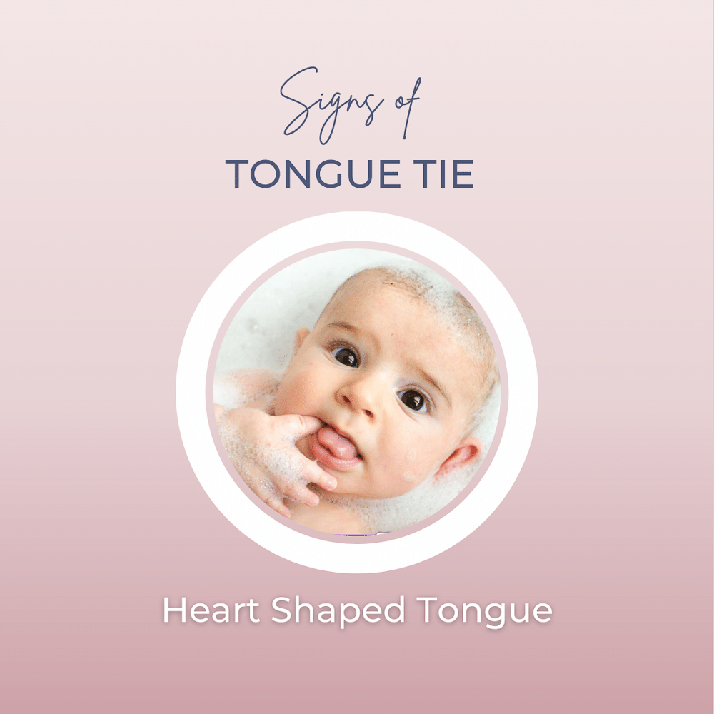 Baby Tongue Tie (Ankyloglossia) — Lactation Consultant Charleston, SC