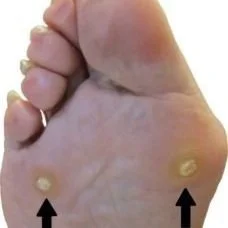 Corns Treatment Birmingham — Dr Foot Podiatry Clinic