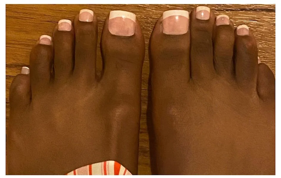 Corn Removal — Dr Foot Podiatry Clinic