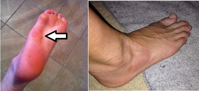 Cuboid Syndrome Treatment Birmingham — Dr Foot Podiatry Clinic