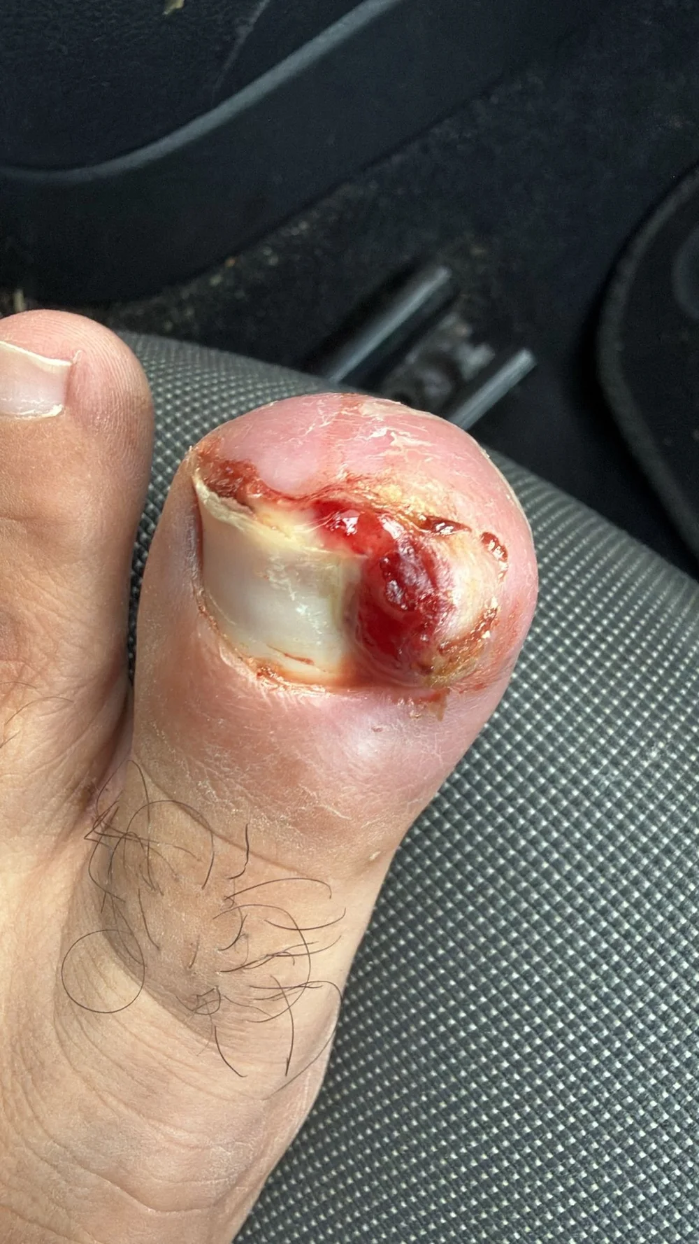 Ingrowing Toenails: Causes, Treatment & Phenol Nail Surgery — Dr Foot ...