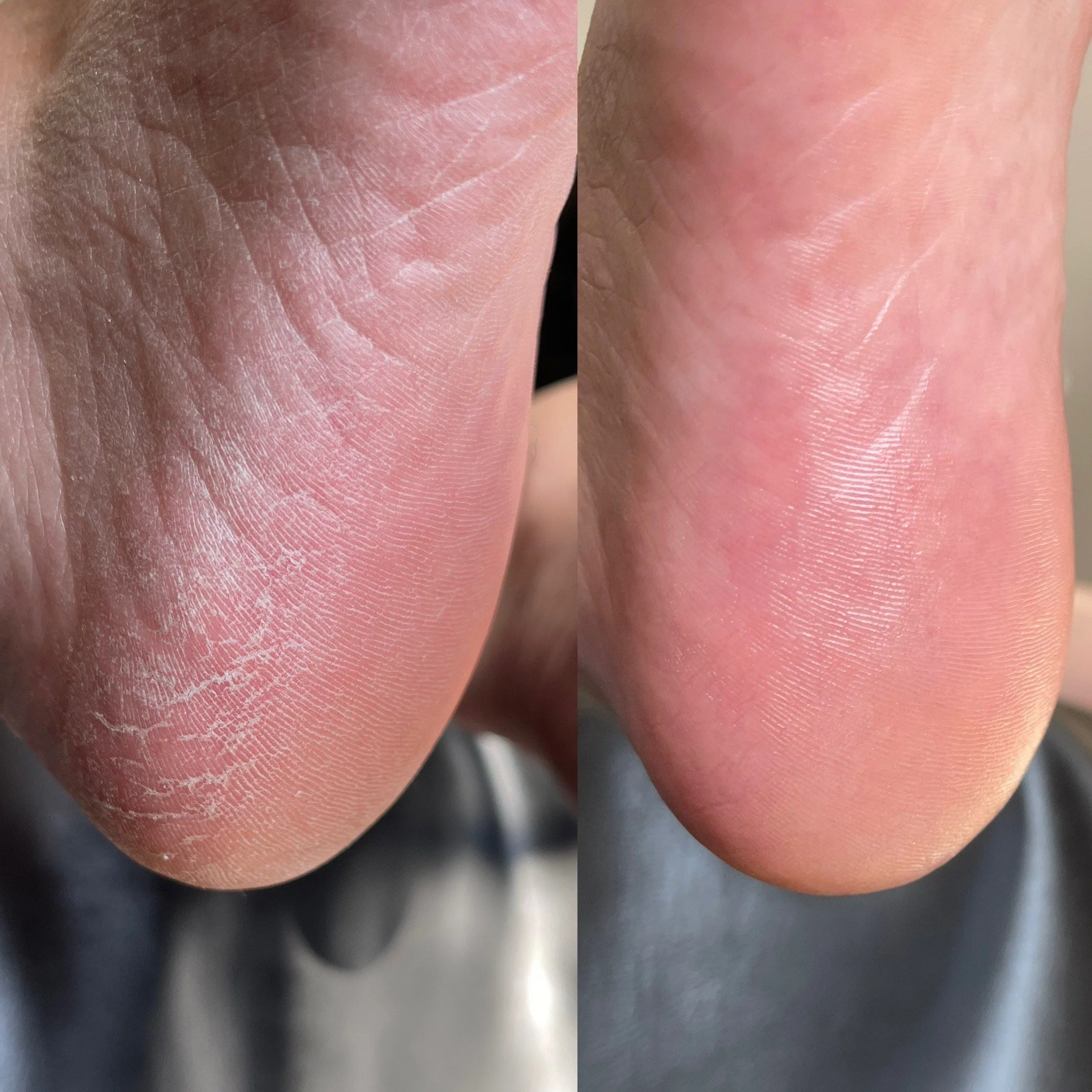 Waterless Pedicure — Synergy Skin And Nails