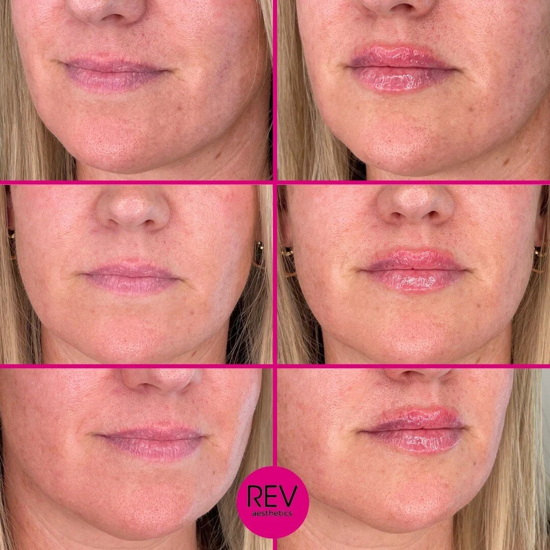 REV Aesthetics- Tracey McClelland, RN