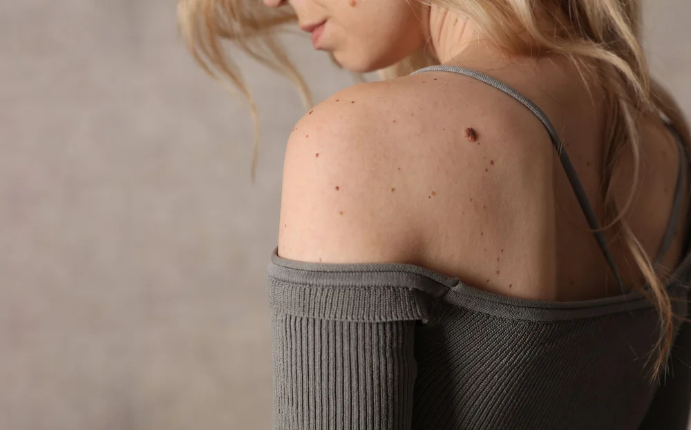 Benign Lesion Removal Treatment | Kelowna | Interior Dermatology Centre