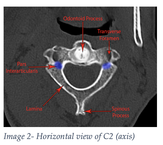 Cervical Spine Fractures: Snap, crackle, and Pop — Emergency Medicine ...