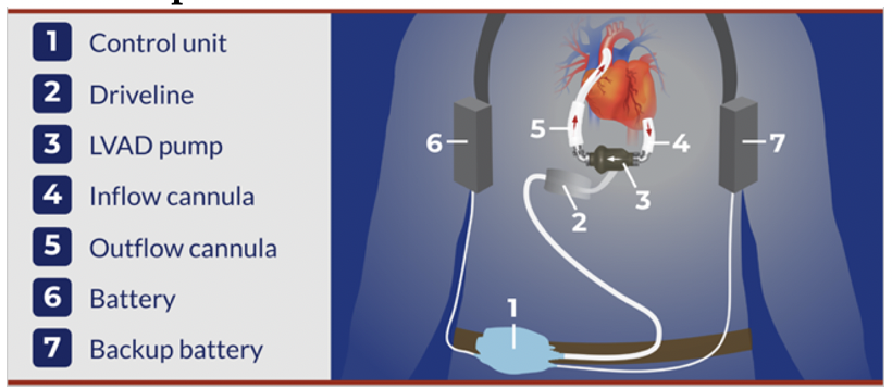 ED approach to LVADs: More Machine than Man — Emergency Medicine Board ...