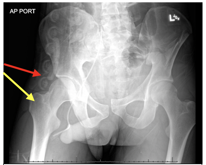Pelvic Fractures: open books can kill! — Emergency Medicine Board Review