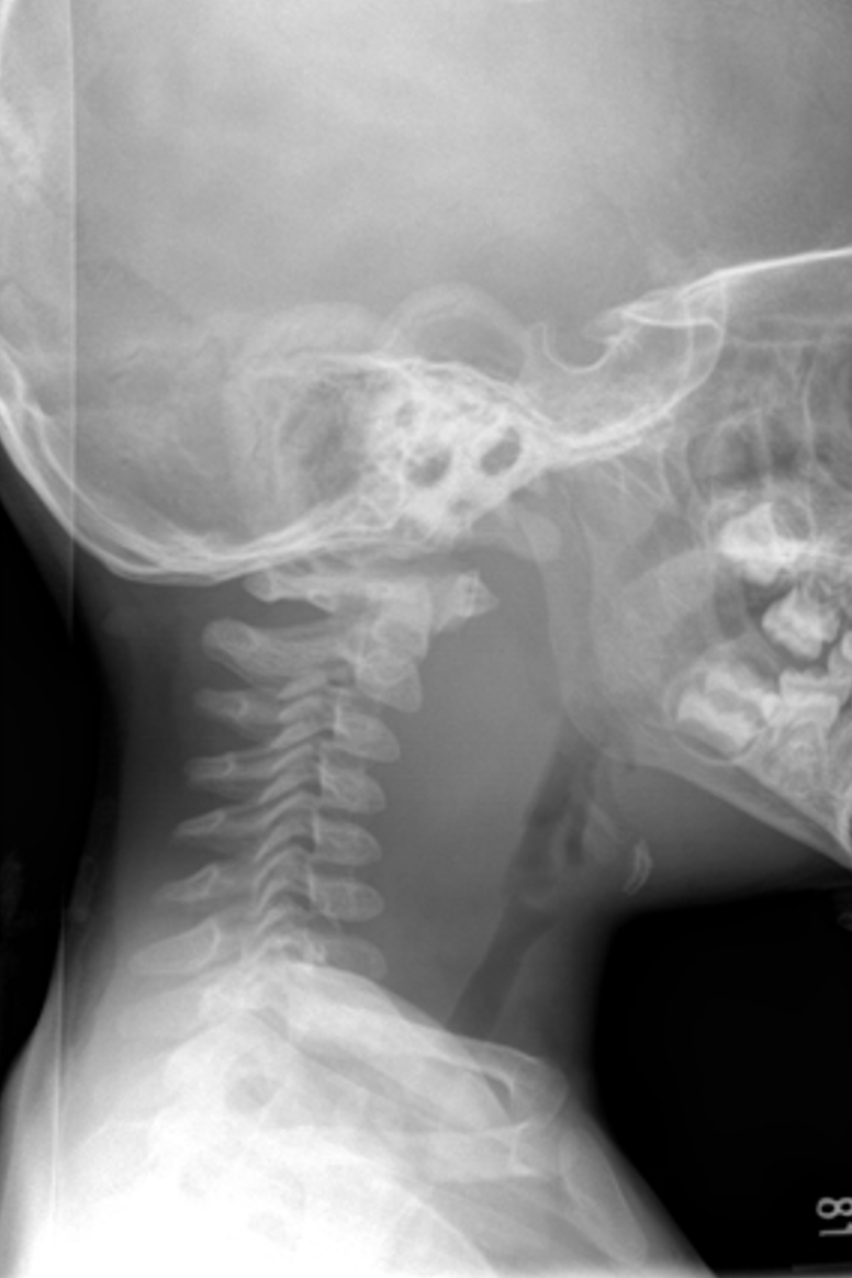 Parapharyngeal Space Abscess