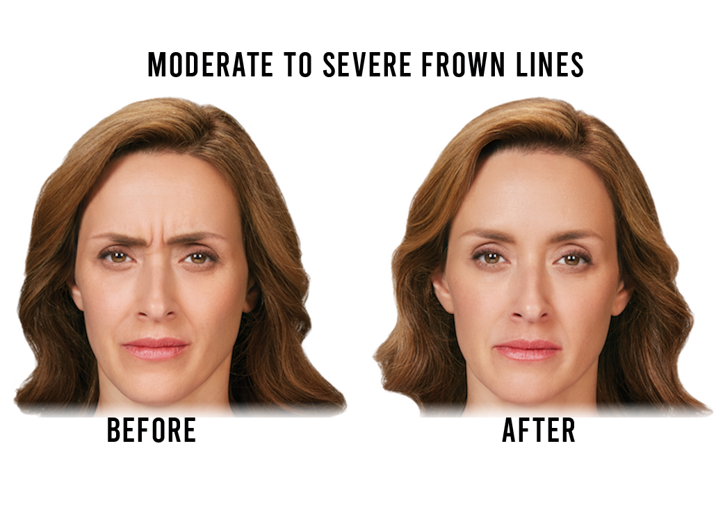 Botox® is a revolutionary treatment with cosmetic applications. Reduce ...