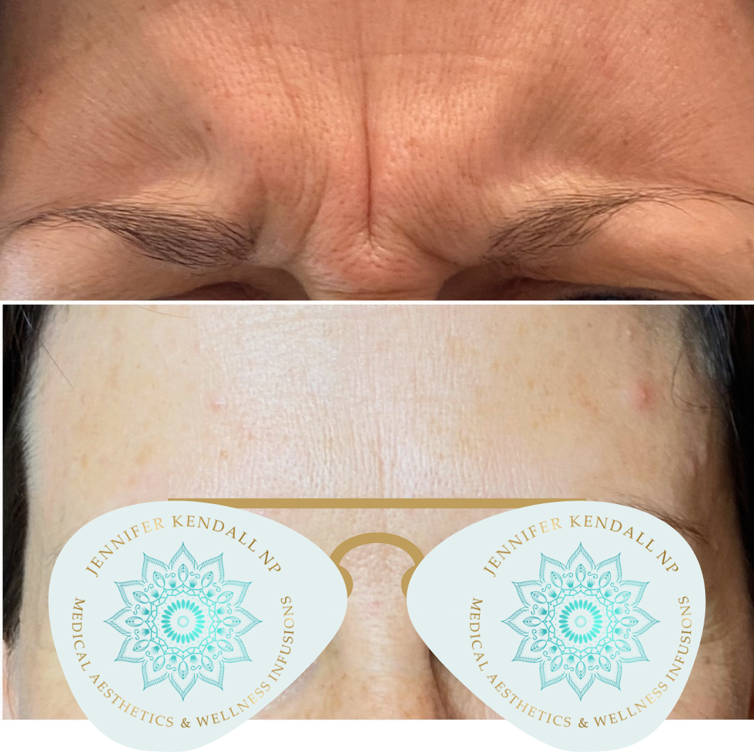 Botox — Jennifer Kendall NP