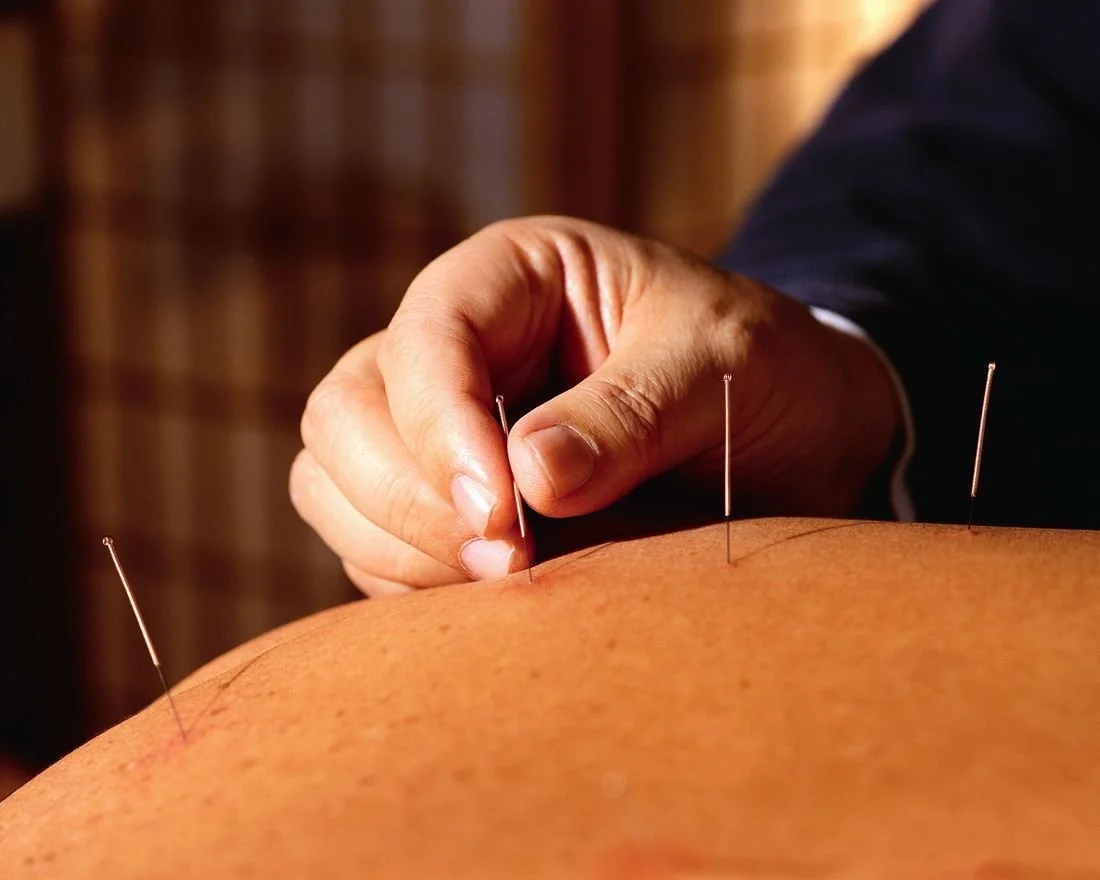 ACUITY ACUPUNCTURE WELLNESS - Deerfield, Illinois