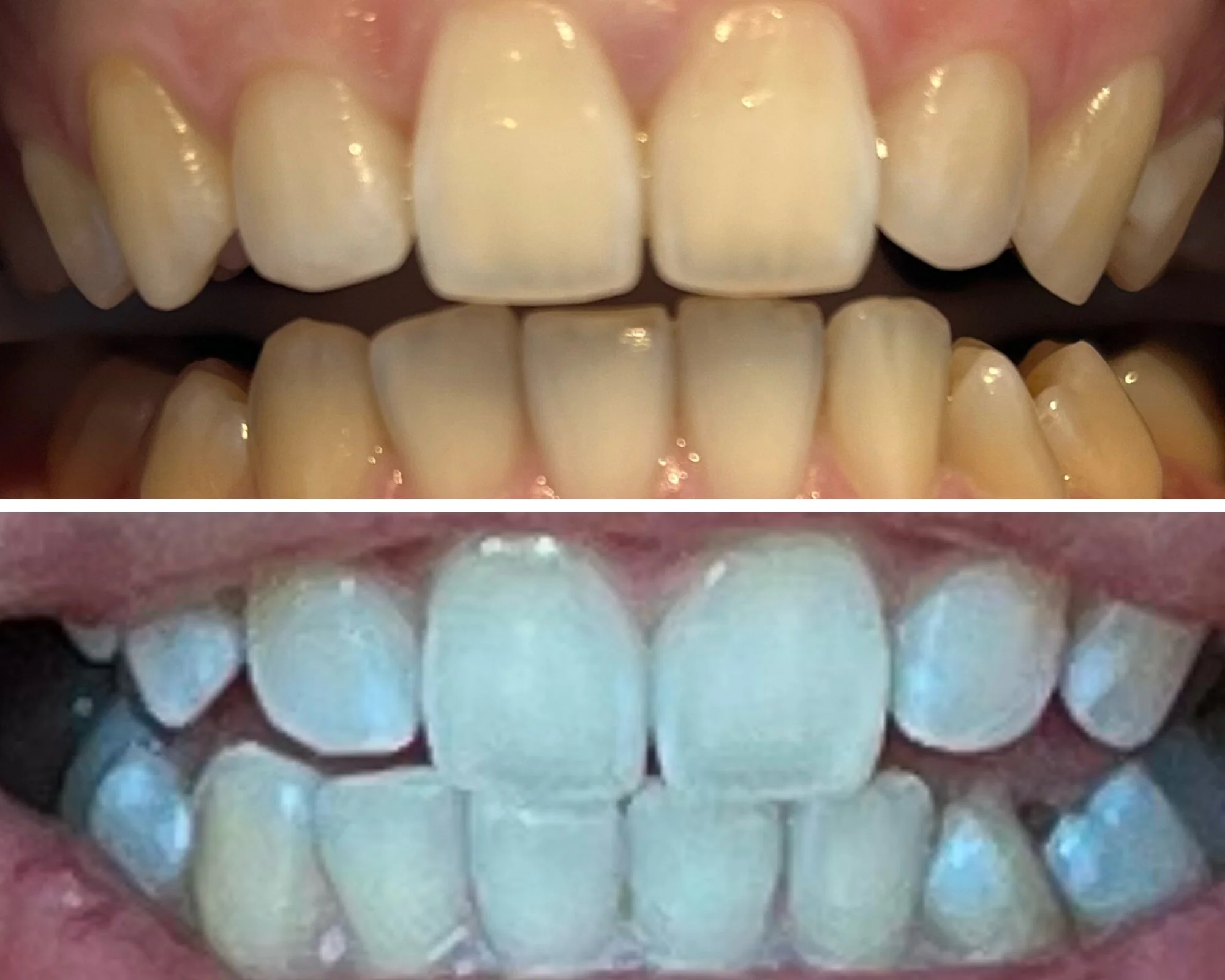 Smile Brighter with Brighter White Smiles: View our Gallery