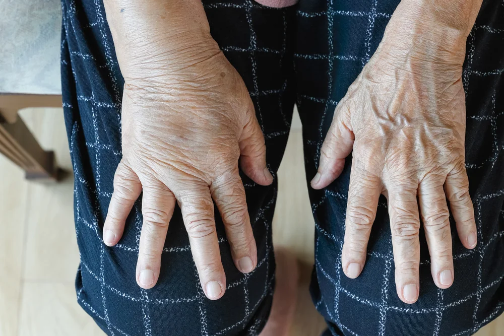 Cancer Rehab PT — The Ultimate Guide to Lymphedema Treatment