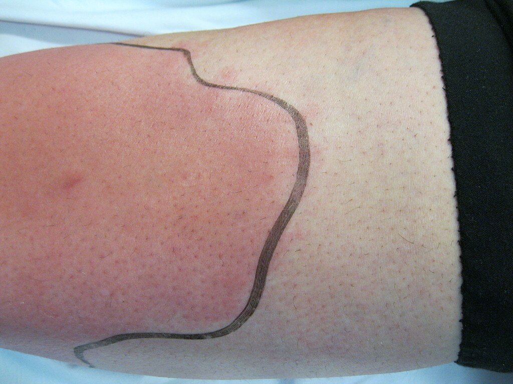 The Cellulitis-Lymphedema Link: Everything You Need to Know - Cancer ...